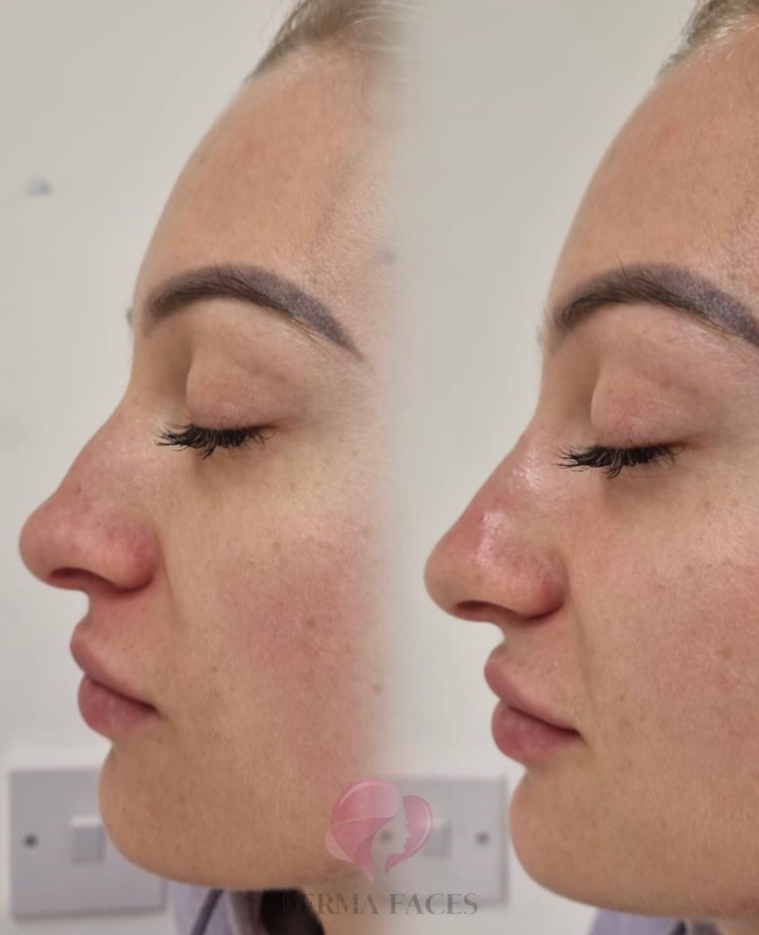 Special Offer - Derma Faces